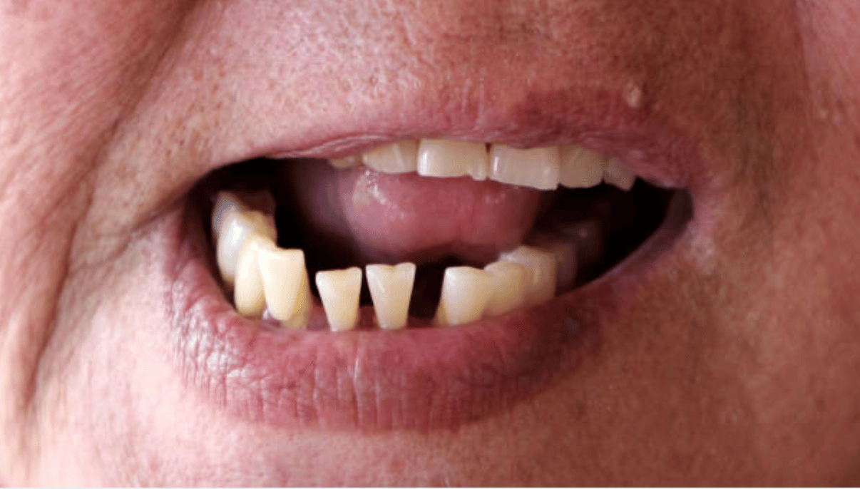 INBRACE Lingual Braces Denver, CO | Behind-The-Teeth Braces