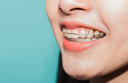 Is It Safe to Make Your Own Retainer? - Advanced Orthodontic Care